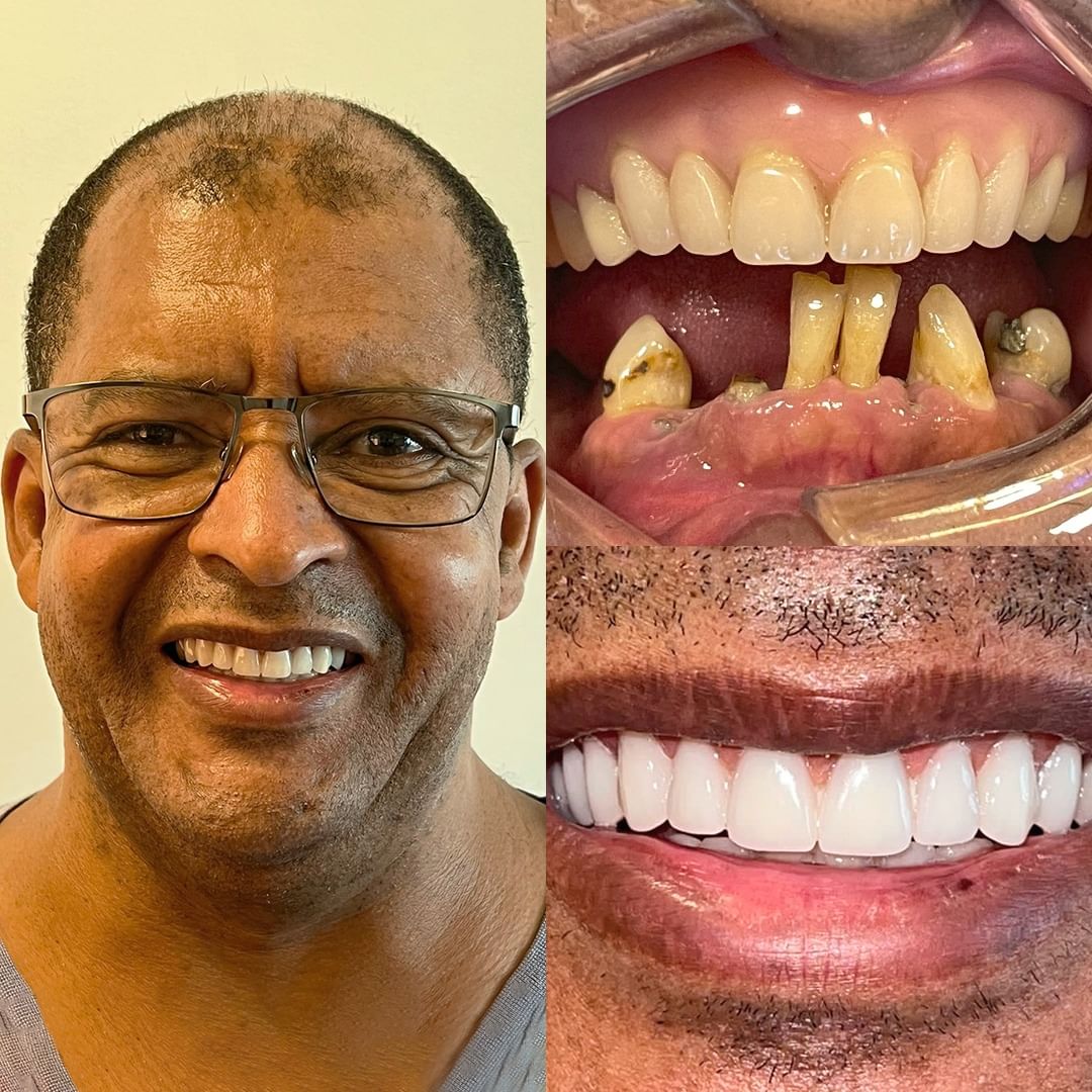 Implante dentário: tudo que você precisa saber sobre o tratamento